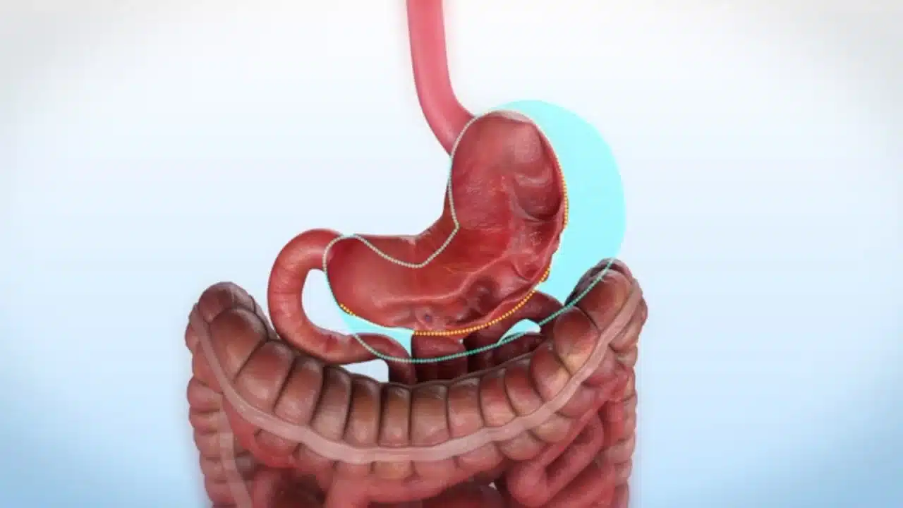 Endoscopic Sleeve Gastroplasty (ESG) Turkey | Istanbul Bariatric Center